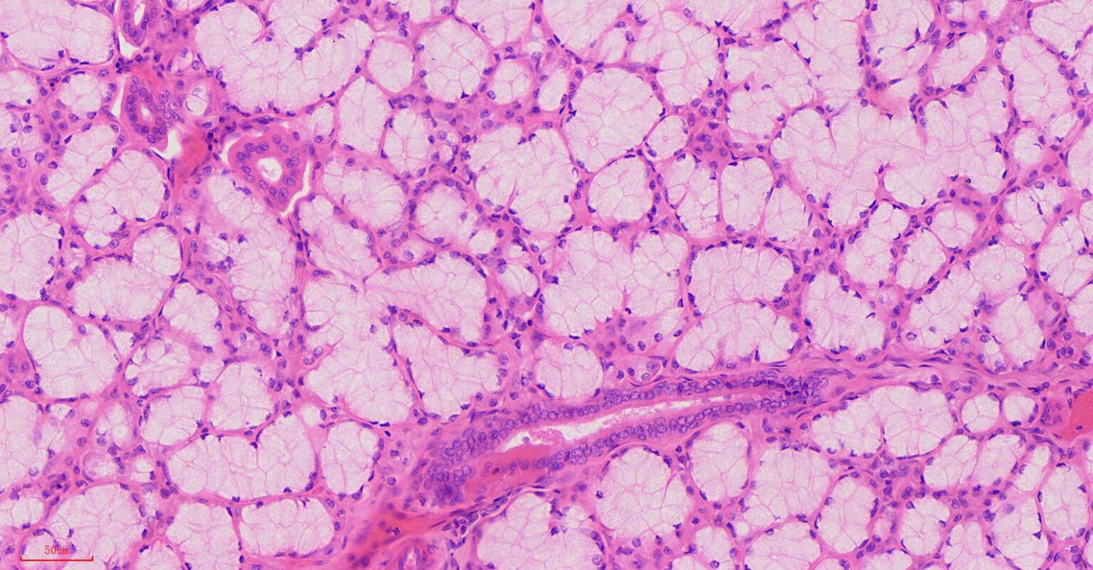 Crosssectional Imaging Of Parotid Gland Nodules A Brief Practical